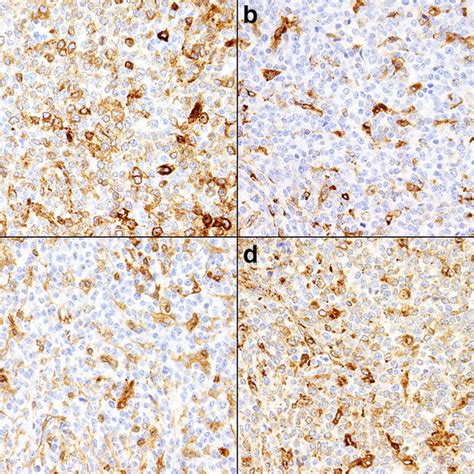 Primary Diffuse Large B Cell Lymphoma Of The Cns With Testicular