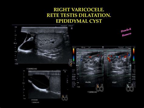 Right Varicocele Ultrasound