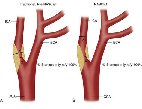 Ultrasound Evaluation Of The Carotid Arteries Clinical Gate
