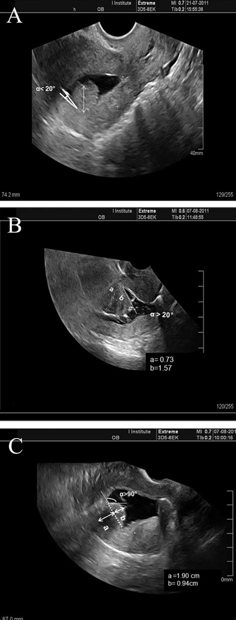 3d Ms Shg Shows A Submucousal Myoma In Longitudinal Section Of The