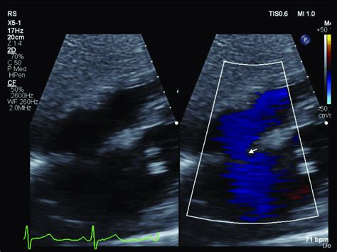 Transthoracic Echocardiography Subcostal View Color Doppler Showing