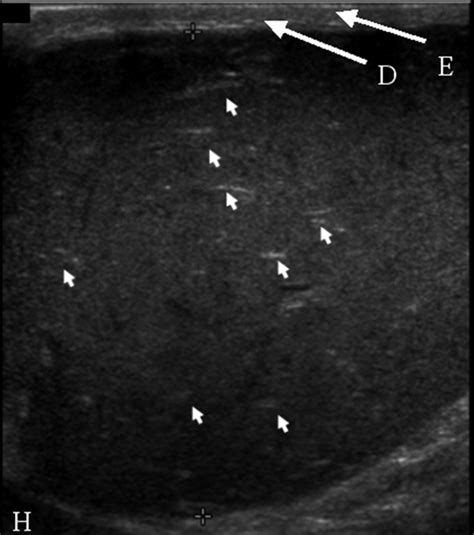 Differences In Sonographic Features Of Ruptured And Unruptured