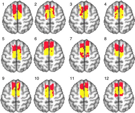 Reproducibility Of Functional Connectivity Defined Clusters Between 12