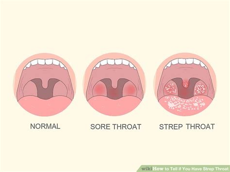 How To Tell If You Have Strep Throat With Pictures Wikihow
