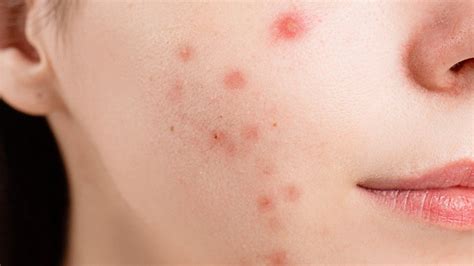 The Ultimate Skincare Routine For Acne Prone Skin Minimalist