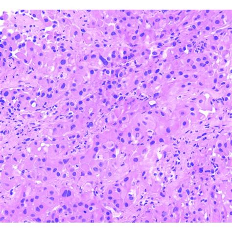 Proliferation Of Large Atypical Cells With Abundant Eosinophilic
