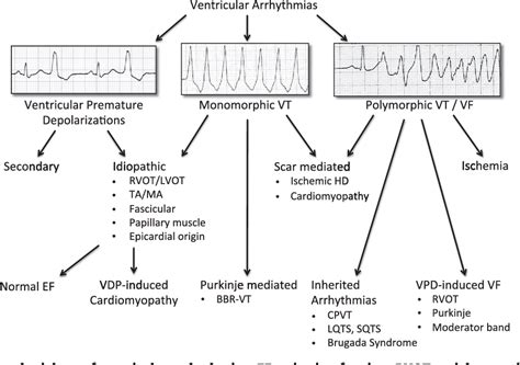 Figure 1 From Ablation Of Ventricular Arrhythmias Semantic Scholar