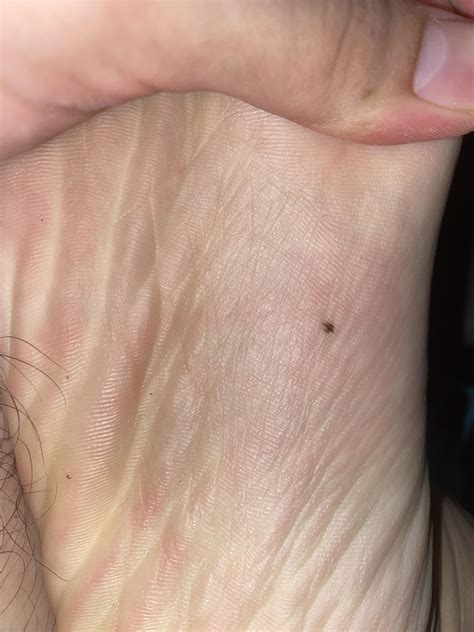 Malignant Melanoma Foot