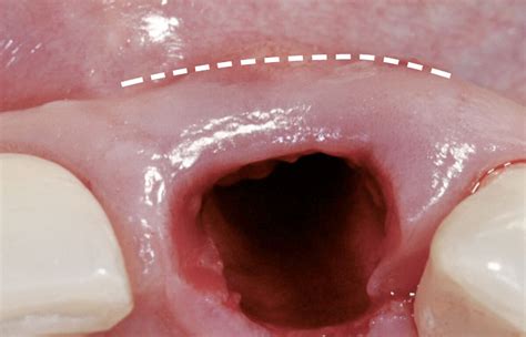 Molar Socket