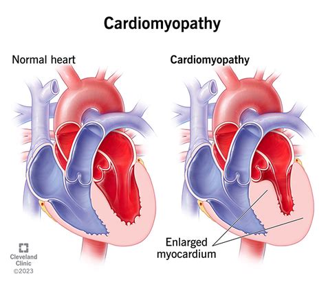 Cardiomyopathy Symptoms And Treatment