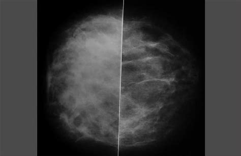 Bilateral Craniocaudal Mammogram Shows Diffuse Increased Density In The