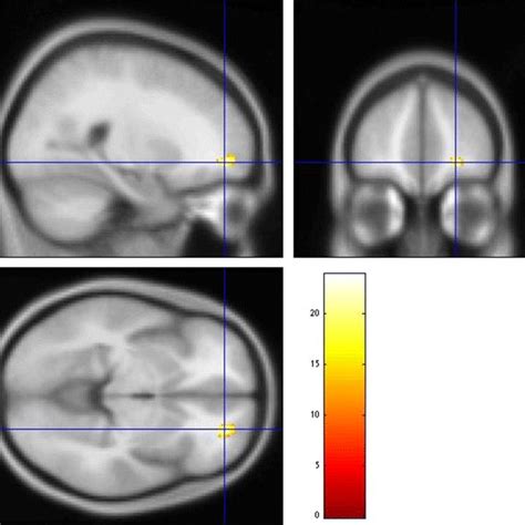 Results Of Genotype Diagnosis Interaction Effects On Brain Morphology
