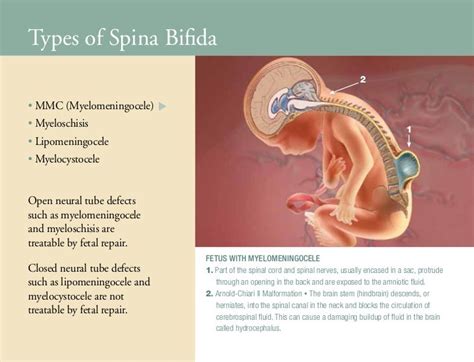 Fetal Surgery For Spina Bifida
