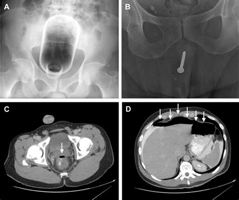 Imaging Foreign Bodies Ingested Aspirated And Inserted Annals Of