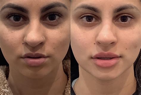Dermal Fillers Before And After Pictures Case 63 Sacramento Ca