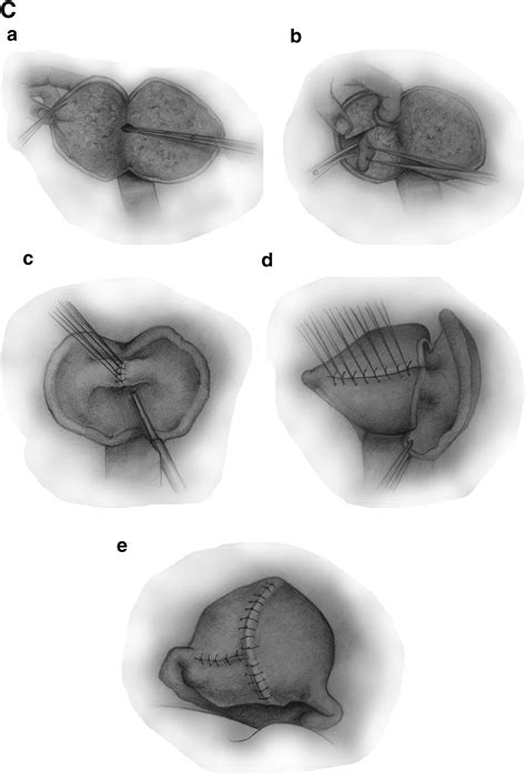 Uterus Sparing Operative Treatment For Adenomyosis Fertility And