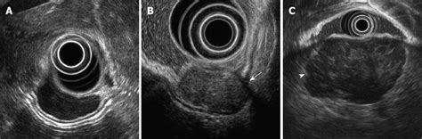 Is It Possible To Differentiate Gastric Gists From Gastric Leiomyomas