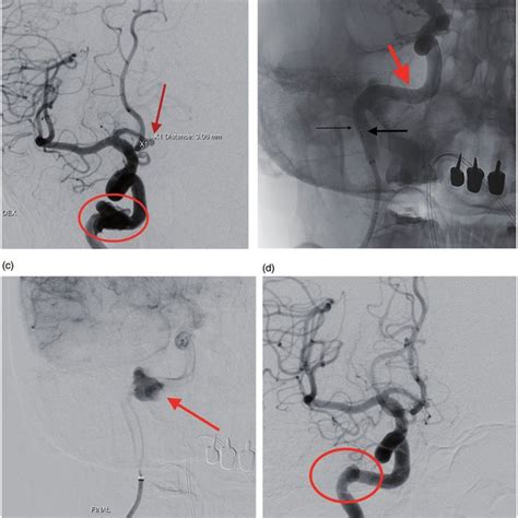 A Digital Subtraction Angiogram Dsa Image Demonstrates A Lobulated