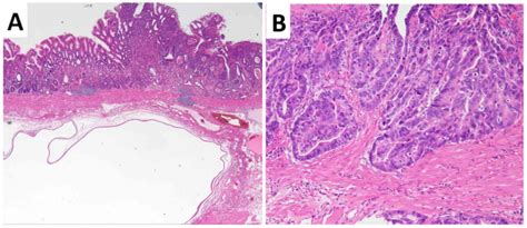 Early Gastric Cancer With Multiple Submucosal Heterotopic Gastric Gland