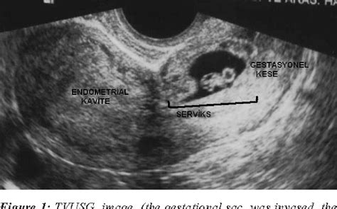 [pdf] Cervical Ectopic Pregnancy Three Case Reports Semantic Scholar