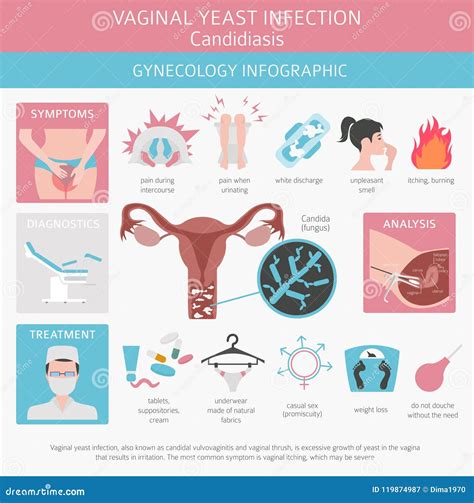 Vaginal Yeast Infection Candidiasis Stock Vector Illustration Of