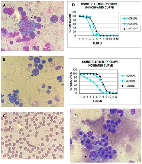 Clinical Presentation Of Parvovirus B19 Infection In Adults Living With