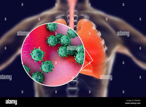 Viral Pneumonia Conceptual Illustration Human Lungs And Close Up View
