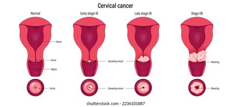 Cervical Dysplasia Leep