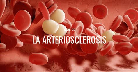 La Arteriosclerosis