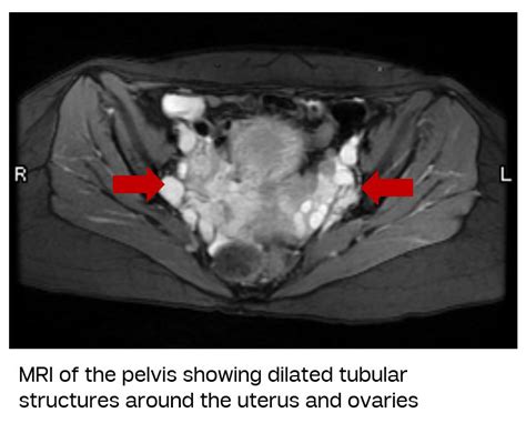 Pelvic Congestion Syndrome Vein Treatment Center
