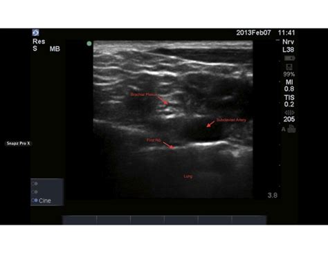 [figure Supraclavicular Ultrasound Guided Brachial Plexus Nerve Block
