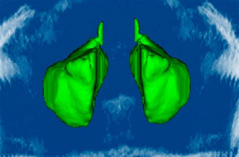 Reconstructed 3 Dimensional Image Of The Maxillary Sinuses For Volume