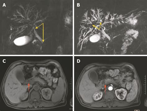 Igg4 Related Sclerosing Cholangitis Associated With Essential