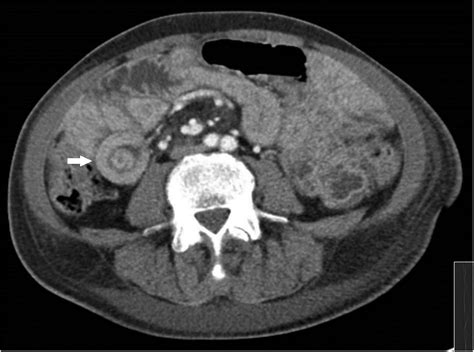 A Case Of Adult Intussusception Bmj Case Reports