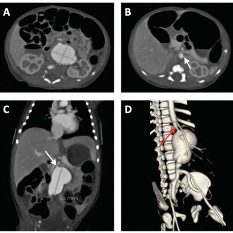 Initial Computed Tomography Angiogram Of Chest Abdomen And Pelvis