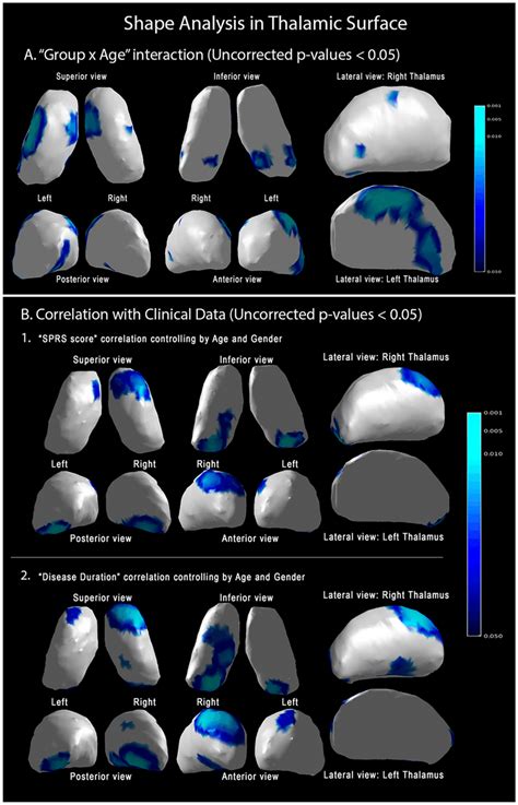A Vertex Wise “group Age” Interaction Related Effects Over Thalamic