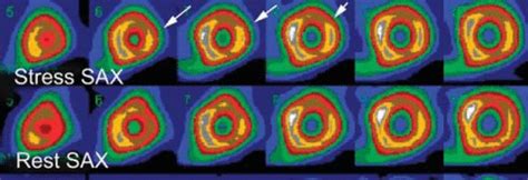 Myocardial Perfusion Scintigraphy Techniques Interpretation