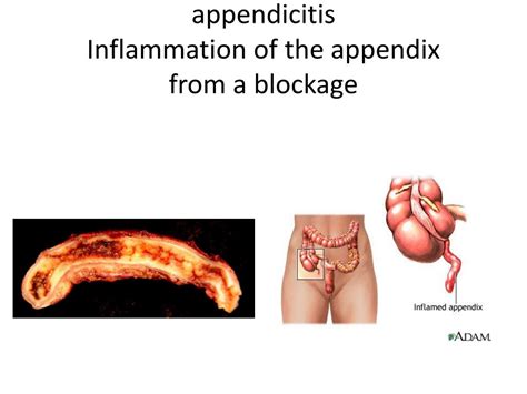 Ppt Appendicitis Inflammation Of The Appendix From A Blockage