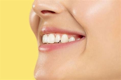 Bisa Ganggu Penampilan Ini Cara Mengatasi Gigi Kuning Dengan Bahan Alami