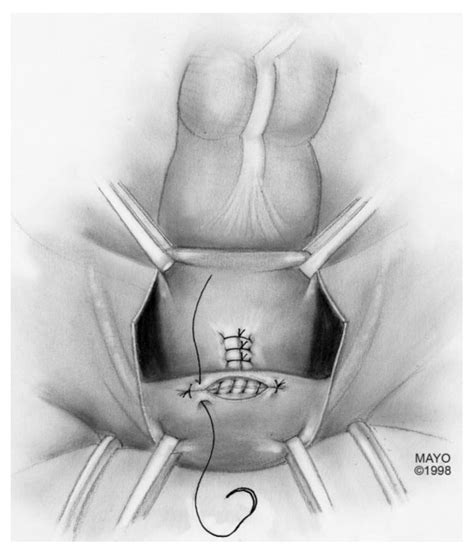 Jcm Free Full Text Colorectal Vaginal Fistulas Imaging And Novel