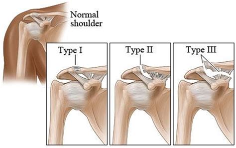 Acromioclavicular Joint Sprain