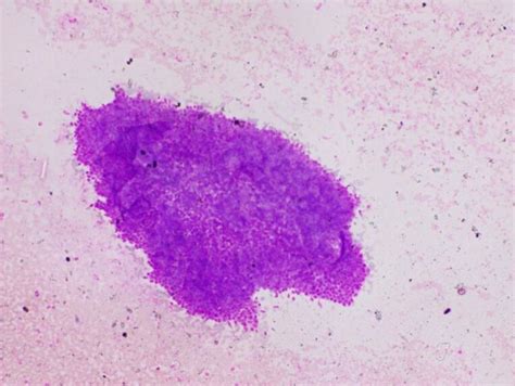 Benign Breast Epithelial Cell Cluster Leishman Stain X 40 Download