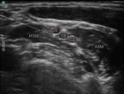 Brachial Plexus Block