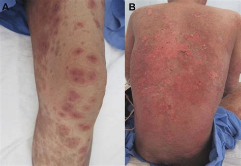 A 33 Year Old Thai Female Diagnosed With Erythema Multiforme Like Acute