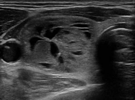 Head And Neck 4 1 Thyroid Gland Case 4 1 2 Thyroid Benign Lesions