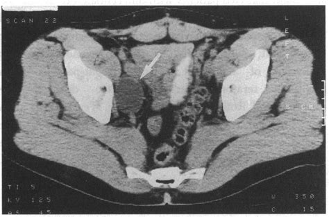 Computerized Tomography Scan Showing Recurrent Pelvic Mass After