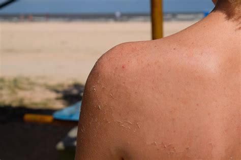 Why Does My Skin Peel When I Get Sunburned And What Should I Do About