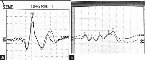 A Normal Cvemp Waveforms B Normal Baep Waveforms Download