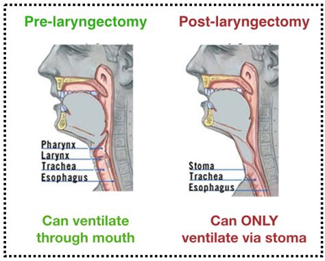 Everyday E B M For The Sake Of The Trach Tracheostomy Basics