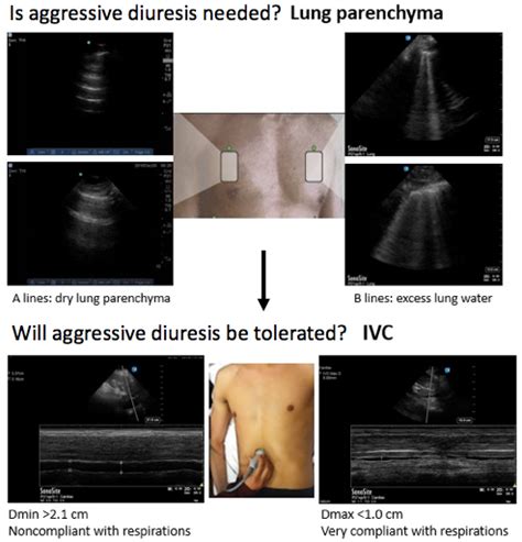 Bedside Ultrasound For Guiding Fluid Removal In Patients With Pulmonary